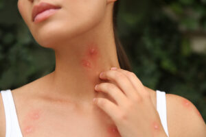 Here is Why Your Oak Trees are Giving You Itchy Bumps and Rashes ...